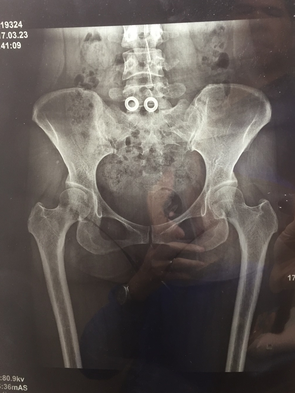 Clinical Pattern Recognition: Hip dysplasia or Hip pain with mobility ...
