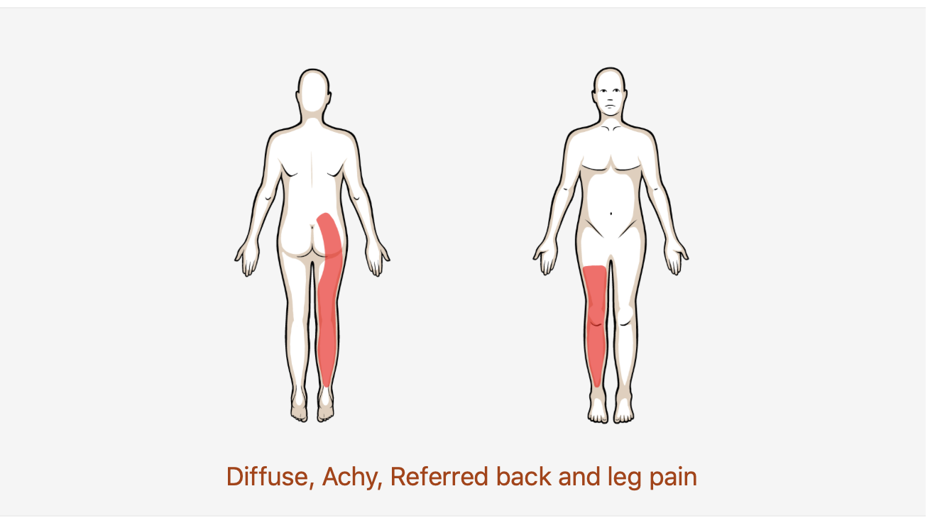 Discogenic Lower Back Pain | Clinical Pattern Recognition